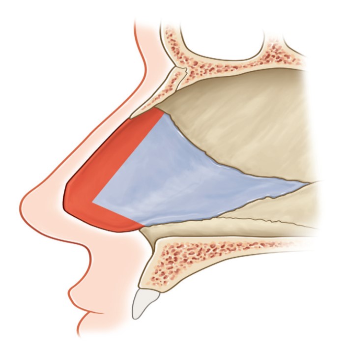 TREATMENT OF DEVIATED NOSE | drshehabbeg.com